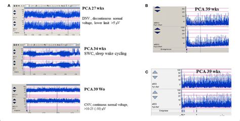A AEEG Findings Of Normal Background Activity In Relation To Download Scientific Diagram