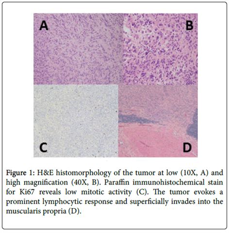 Indolent Gastrointestinal Neuroectodermal Tumor Gnet Of The Col