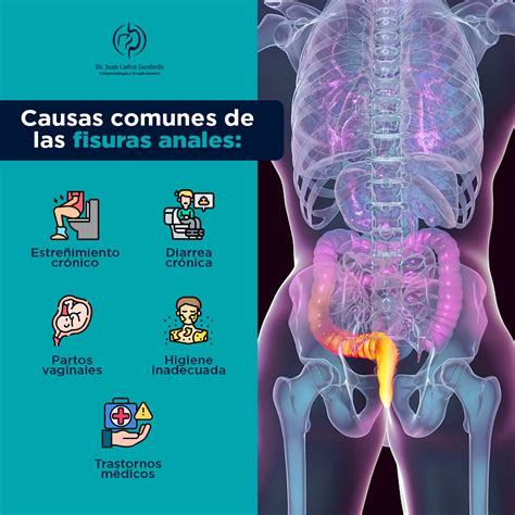 Dr ⚠️ Las Fisuras Anales Son Pequeñas Grietas O Desgarros En La Piel