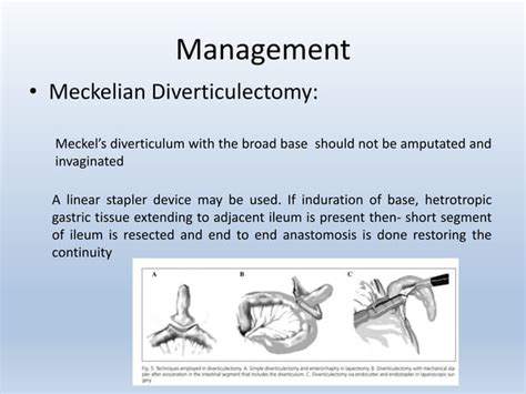 Merkels Diverticulum Pptx
