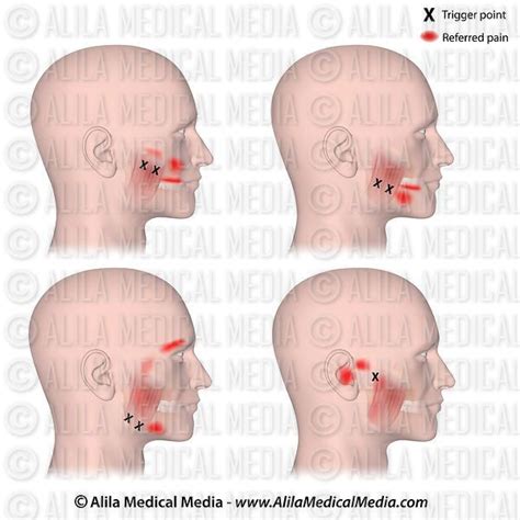 Alila Medical Media Trigger Points And Referred Pain For The