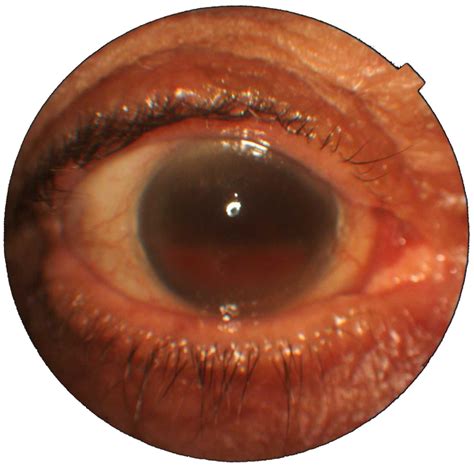 Case Report High Intraocular Pressure Vs Temporal Arteritis A