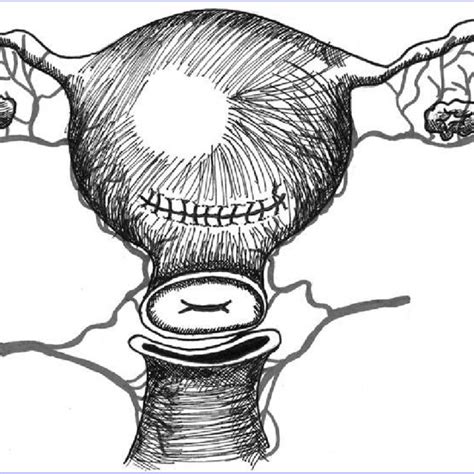 The Circumferential Tearing Of The Vaginal Vault Separating The Cervix