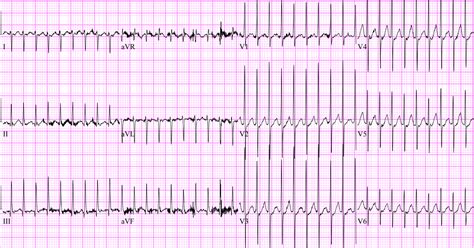 Annals Of B Pod Pediatric Svt Case And Expert Discussion — Taming The Sru
