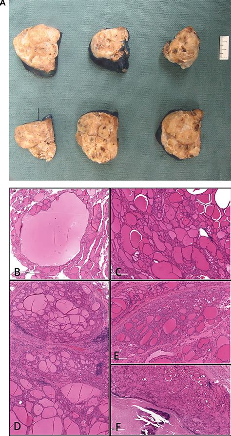 Thyroid Follicular Nodular Disease Grossly The Thyroid Gland Is Download Scientific Diagram