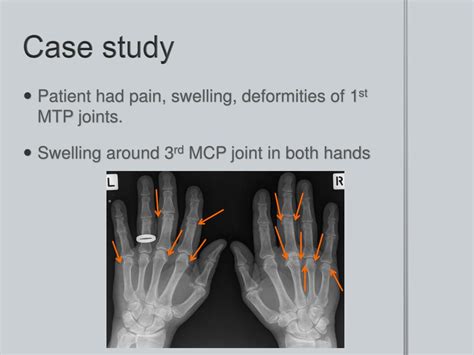 Ppt Gouty Arthritis Adam Roscoe Sam Thomas Year 3 Medical Imaging