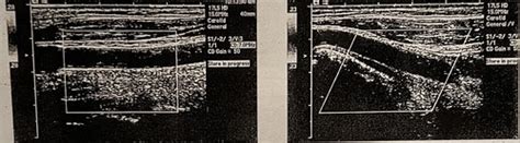 CH Optimizing Color Doppler Images Flashcards Quizlet