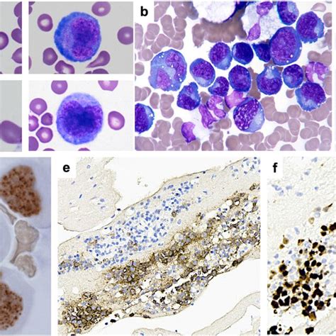 Histologic And Immunophenotypic Features Of Extracavitary Primary