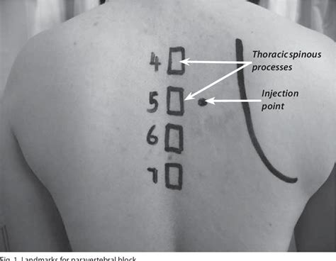 Figure 1 From The Use Of Single Injection Thoracic Paravertebral Block In Breast Cancer