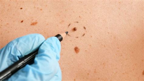 Melanoma Mole Removal