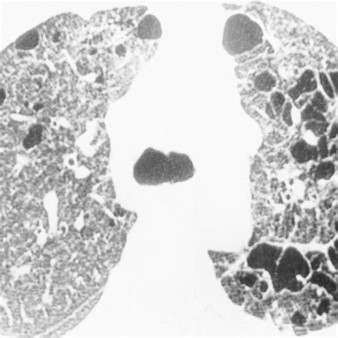 A Chest Radiograph Showing Bilateral Diffuse Miliary Nodular Lesions