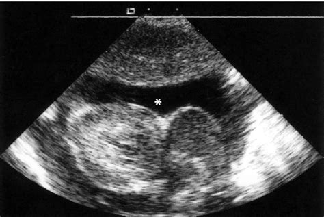 Echocardiogram Subxiphoid View Shows Circumferential Pericardial