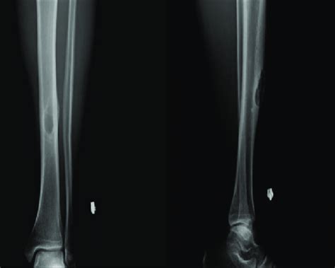 Anteroposterior And Lateral Radiographs Of The Left Tibia And Fibula