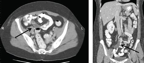 Ct Scan Appendix Mucocele Arrow Download Scientific Diagram