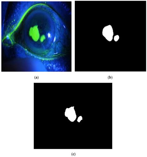 Automated Detection Of Corneal Ulcer Using Combination Image Processing