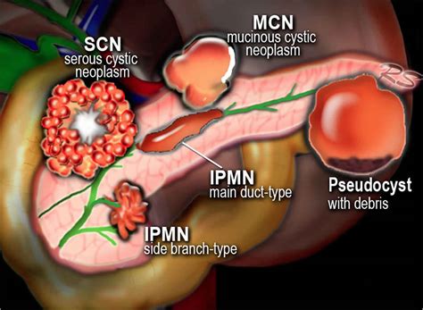 Mucinous Cystic Neoplasm Pancreas Causes Symptoms Diagnosis Treatment And Prognosis