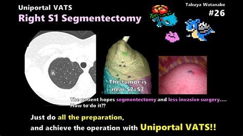 No 26 Uniportal Vats Right S1 Segmentectomy 単孔式胸腔鏡下右肺s1区域切除術【高画質hd】 Youtube