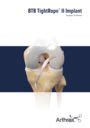 Arthrex Acl Tightrope® Ii Implant