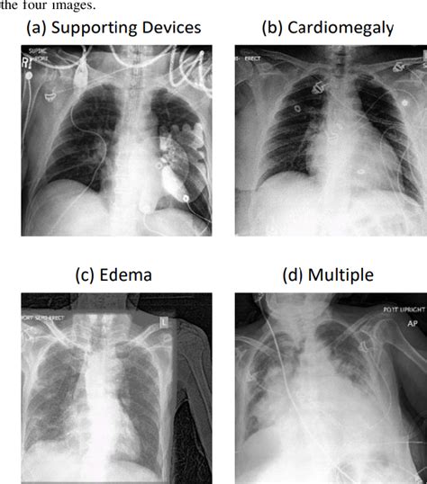 Figure 1 From Deep Learning For Condition Detection In Chest Radiographs A Performance