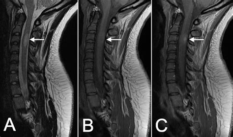 Imaging Of The Spine And Spinal Cord Concise Medical Knowledge