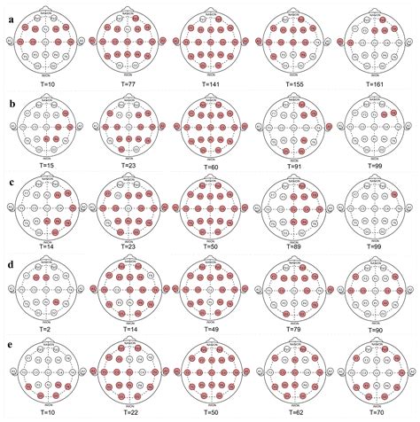 Seizure Onset Zone Detection Based On Convolutional Neural Networks And Eeg Signals