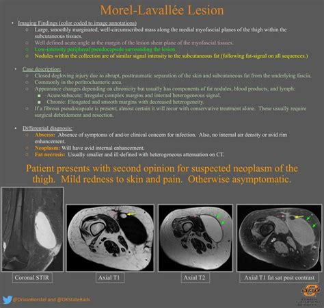 Morel Lavallée Lesion Msk Radiology Imaging Findings Msk