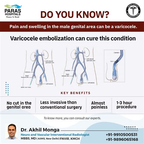 Varicocele Embolization Varicocele Embolisation Pelvic Congestion