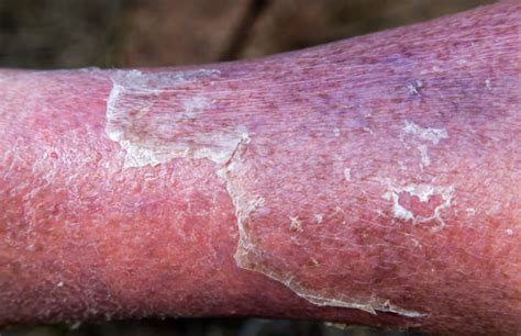 Cellulitis Bacterial Skin Soft Tissue Infection Disease Causes