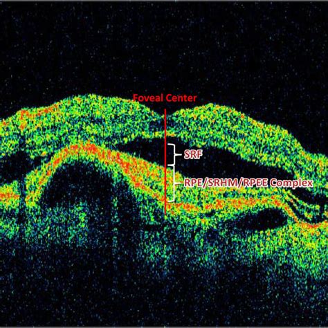 A Location Of Oct Fluid Intra Retinal Fluid Sub Retinal Fluid Download Scientific Diagram