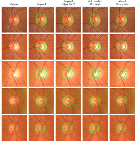 Od And Cup Segmentation Results The Second Automatic Result Without Download Scientific