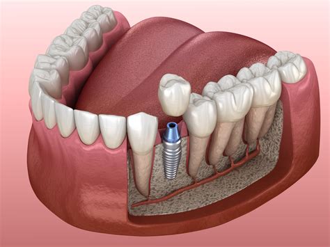 How To Regrow Bone Loss From Periodontal Disease Gum Regeneration