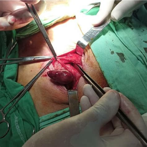 A Femoral Hernia Containing A Necrotic Top Vermiform Appendix