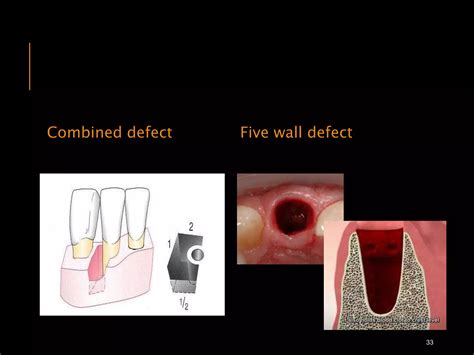 Periodontal Bone Defects Pptx