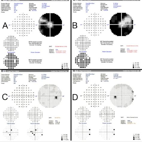Multifocal Ergs Of Patient 2 Multifocal Erg Test Diopsys® Mferg Shows