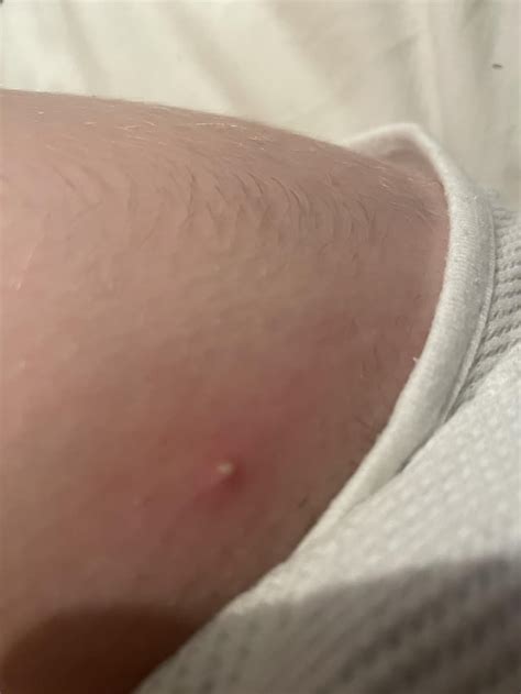 Please Help Does This Look Like Mrsa Rmrsa