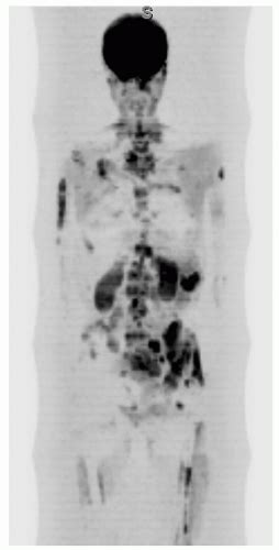 Diffuse Marrow Diseases Musculoskeletal Key Diffuse Marrow Diseases Musculoskeletal Key