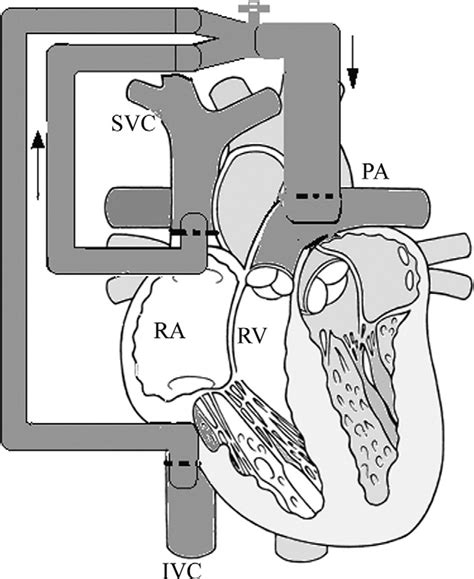 Temporary Total Cavopulmonary Connection T TCPC System The Superior Download Scientific