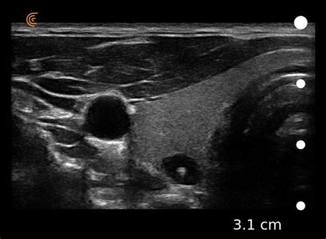 Clarius Ultrasound Scanner For Iphone And Android Uds