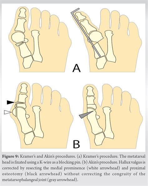 Distal Metatarsal And Proximal Phalangeal Osteotomies Without Soft Tissue Procedure For Hallux