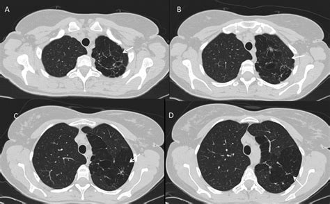 Chest Ct Scan Areas Of Unilateral Emphysema And Cystic Bronchiectasis