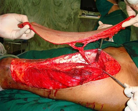 Upper Limb Surgery Keralas Leading Centre For Cosmetic