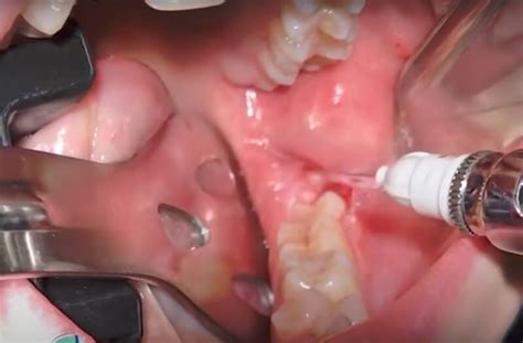 Wisdom Teeth Bleeding Tips For A Speedy Recovery 2023