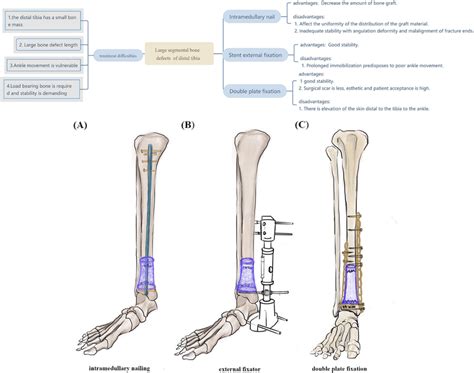 A Figure Simulating The Situation Of Intramedullary Nail Fixation In A Download Scientific