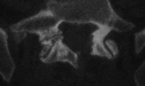 Daily Dose Unilateral Pars Defect