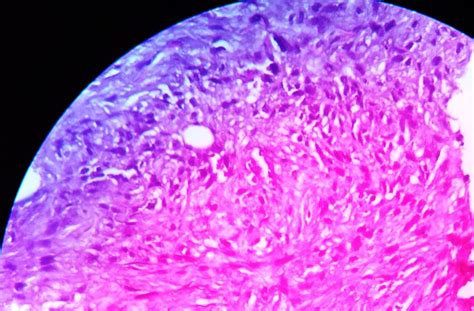 Microphotograph Showing The Pleomorphic Spindle Cells In Fascicles Download Scientific Diagram