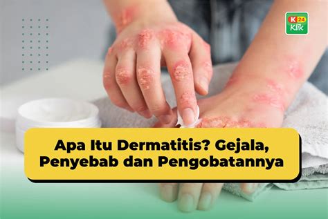 Apa Itu Dermatitis Gejala Penyebab Dan Pengobatannya K24klik