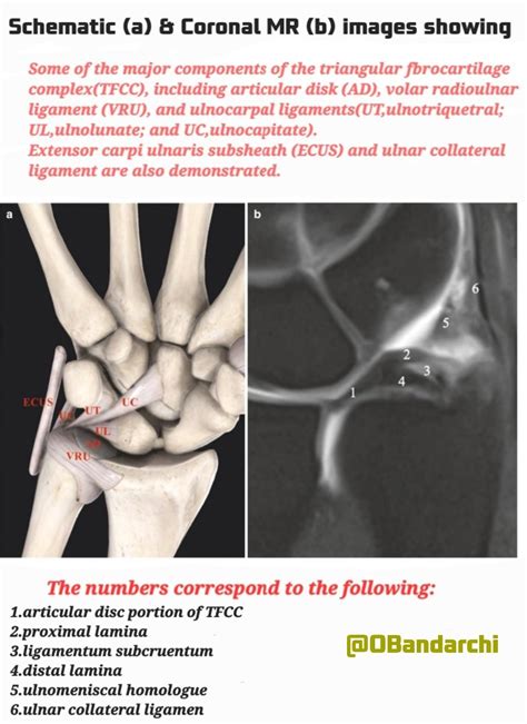 Triangular Fibrocartilage Complex Triangular Fibrocartilage Complex