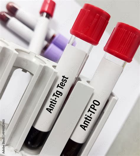 Blood Sample For Thyroid Peroxidase Antibodies Or Anti Tpo Test And