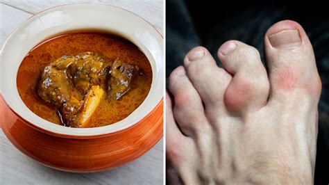 10 High Uric Acid Symptoms To Watch In Male And Female Foods To Avoid And Eat In Hyperuricemia