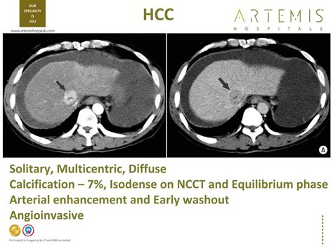 Tpct Triphasic Ct Scan Liver Ppt